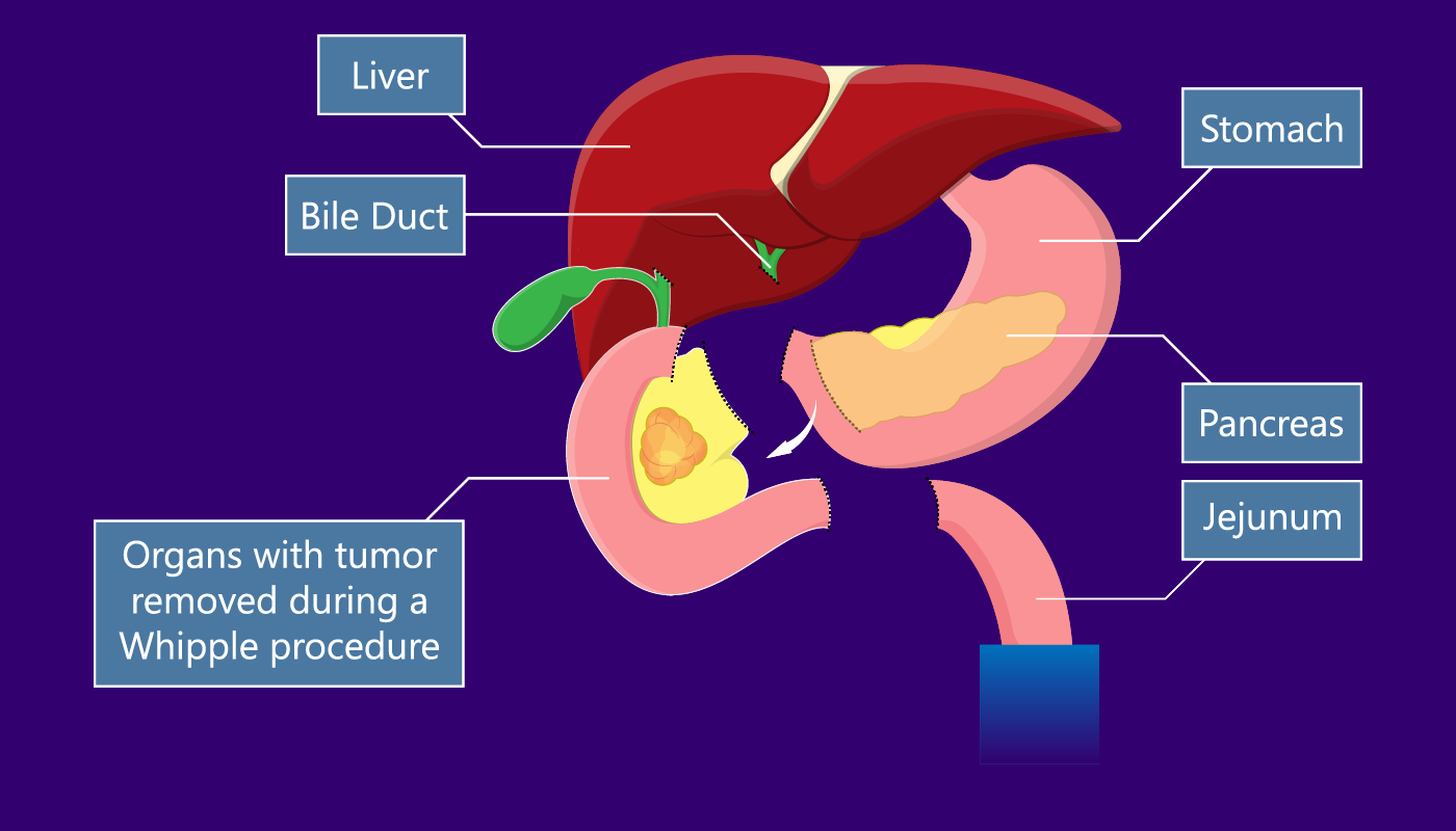 Whipple Procedure MemorialCare