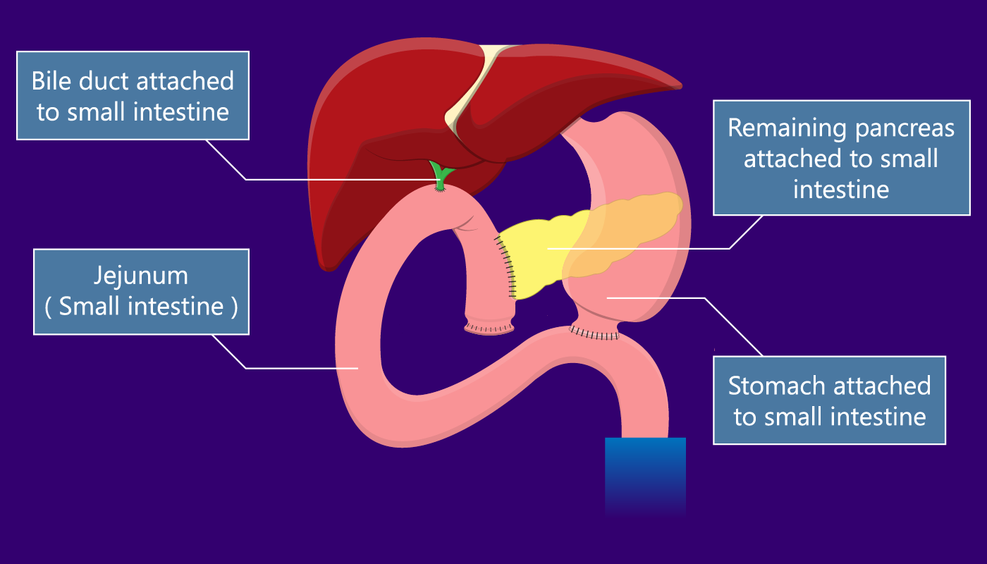 Whipple Procedure MemorialCare